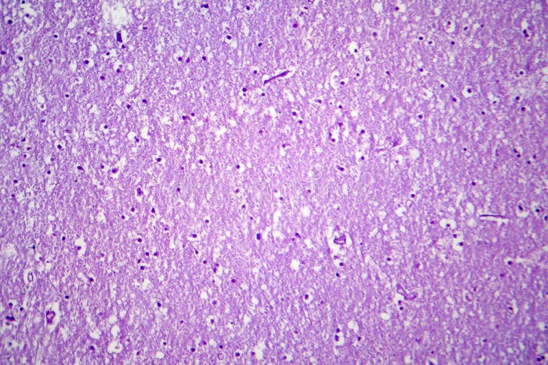 Histopathology of Japanese Encephalitis, Light Micrograph Stock Photo ...