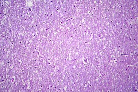 Histopathology of Japanese Encephalitis, Light Micrograph Stock Photo ...