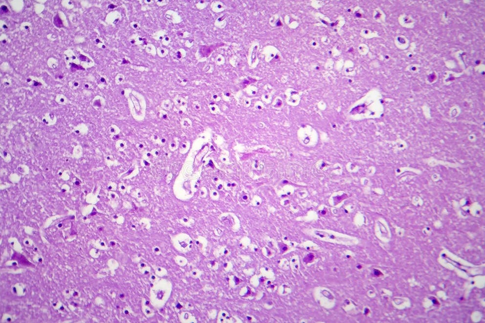 Histopathology of Japanese Encephalitis, Light Micrograph Stock Photo ...