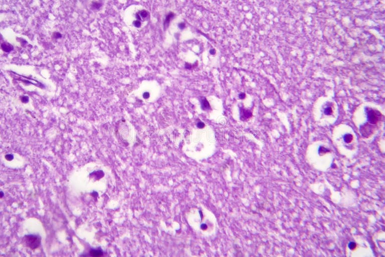 Histopathology of Japanese Encephalitis, Light Micrograph Stock Image ...