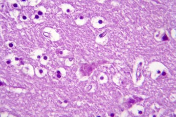 Histopathology of Japanese Encephalitis, Light Micrograph Stock Image ...