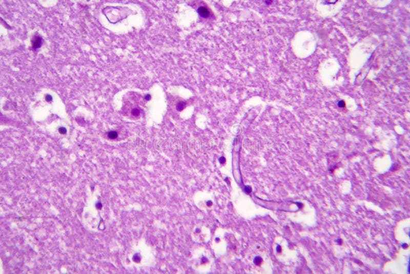 Histopathology of Japanese Encephalitis, Light Micrograph Stock Image ...