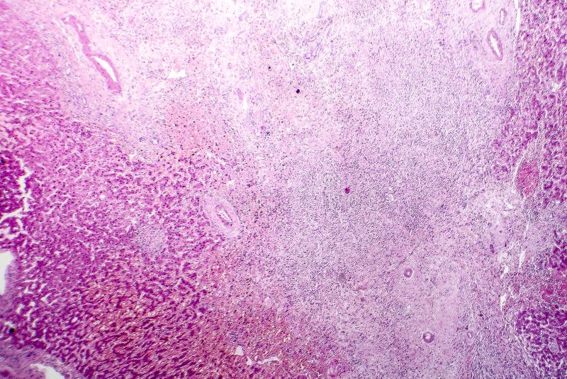 Histopathology of Liver Abscess Stock Image - Image of medical ...