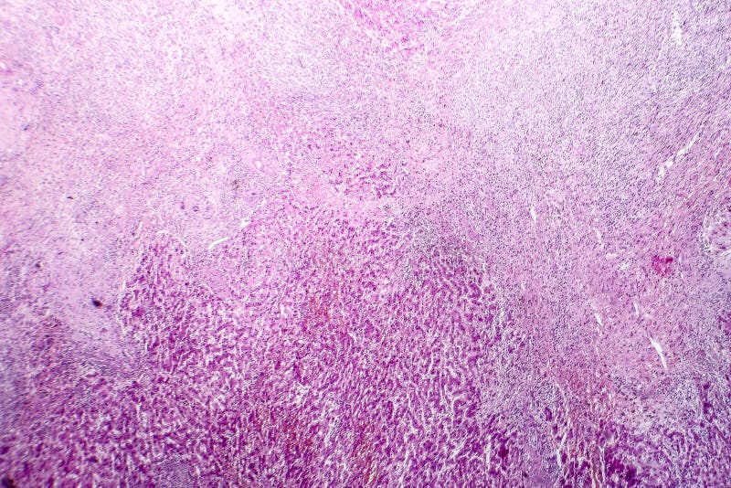 Histopathology of Liver Abscess Stock Image - Image of liver ...