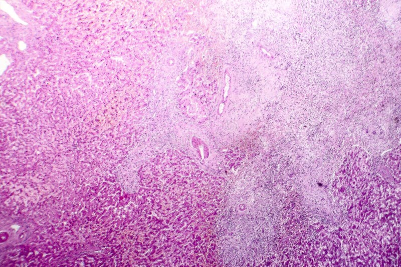 Histopathology of Liver Abscess Stock Photo - Image of microphotograph ...