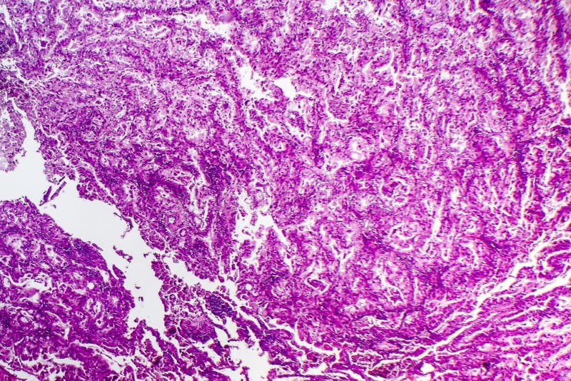 Histopathology of Lung Cancer Stock Photo - Image of medical, neoplasia ...