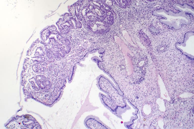 Histopathology of Nasal Polyps Stock Photo - Image of medicine ...