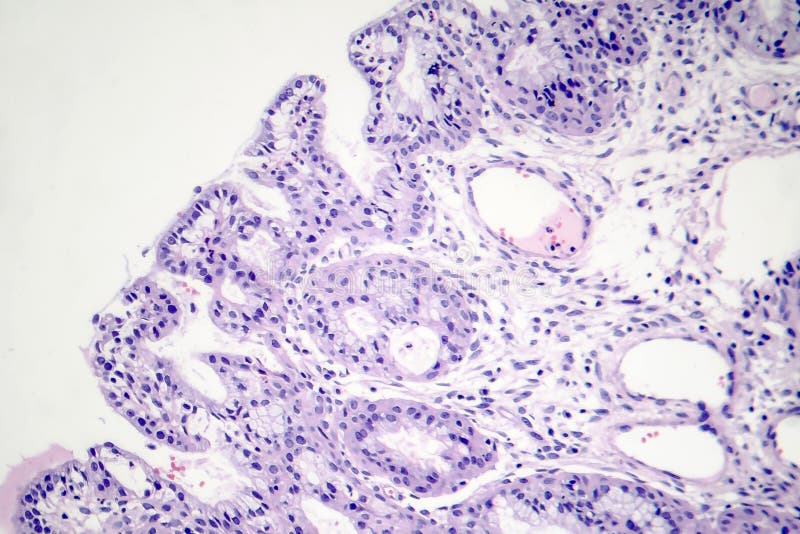 Histopathology of Nasal Polyps Stock Photo - Image of nose, polyp ...