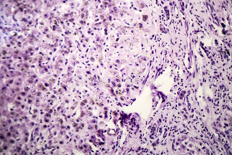 Histopathology Of Liver Abscess Stock Image - Image of science, abscess ...