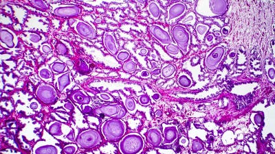 Histopathology of Prostate Gland Hyperplasia Stock Image - Image of ...