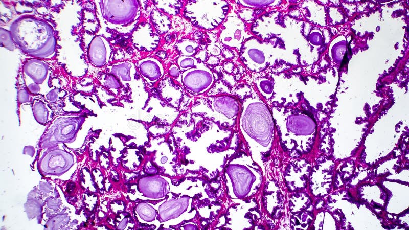 Histopathology of Prostate Gland Hyperplasia Stock Photo - Image of ...