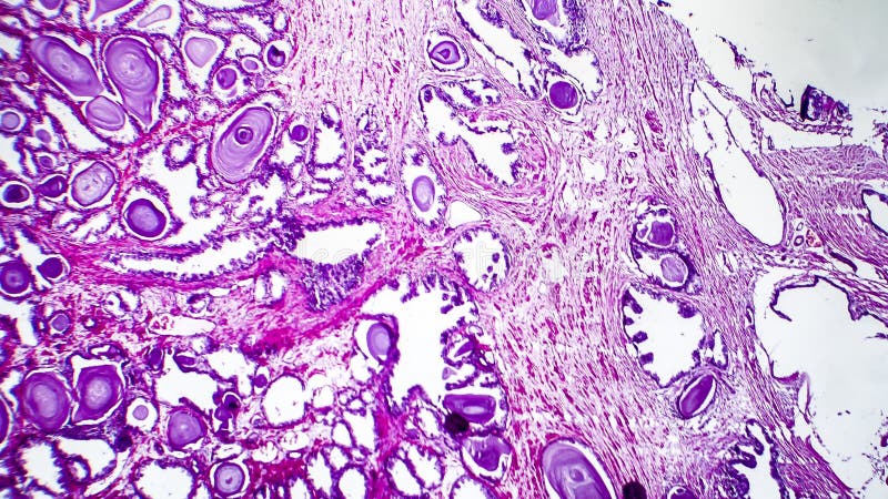 Histopathology of Prostate Gland Hyperplasia Stock Photo - Image of ...