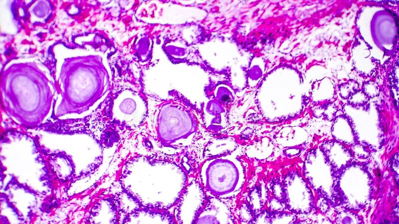 Histopathology of Prostate Gland Hyperplasia Stock Image - Image of ...