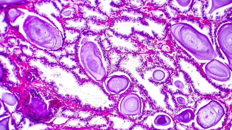 Histopathology of Prostate Gland Hyperplasia Stock Photo - Image of ...