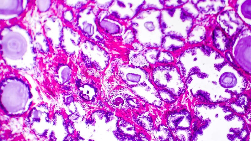 Histopathology of Prostate Gland Hyperplasia Stock Photo - Image of ...