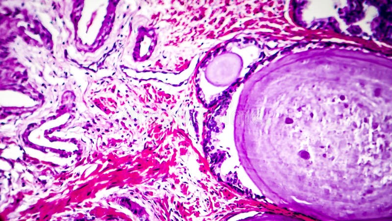Histopathology of Prostate Gland Hyperplasia Stock Photo - Image of ...