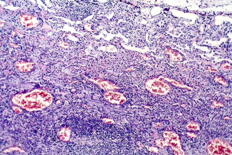 Histopathology of Tuberculosis Lesion Stock Photo - Image of ...