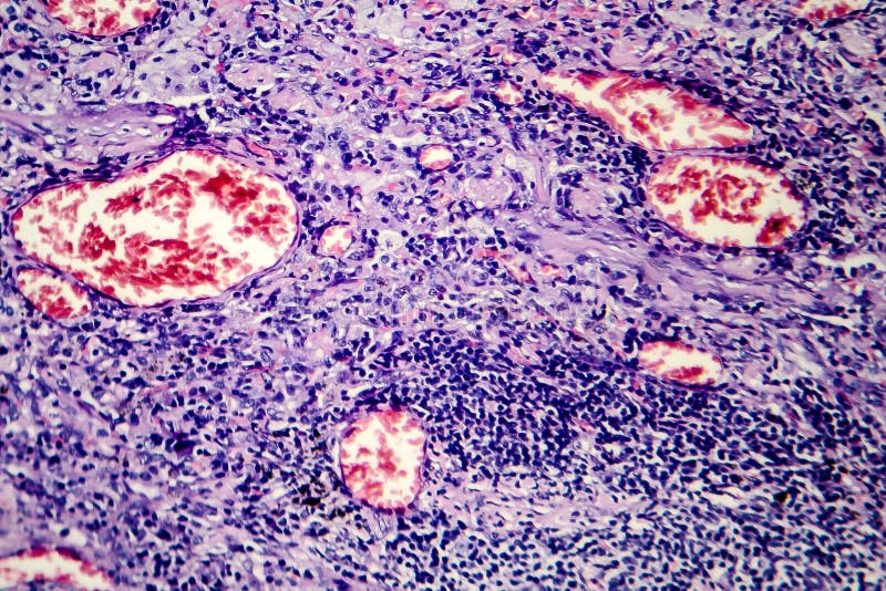 Histopathology of Tuberculosis Lesion Stock Photo - Image of ...