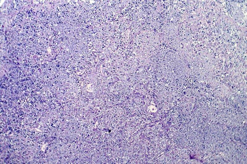 Histopathology of Tuberculosis Lesion Stock Photo - Image of ...