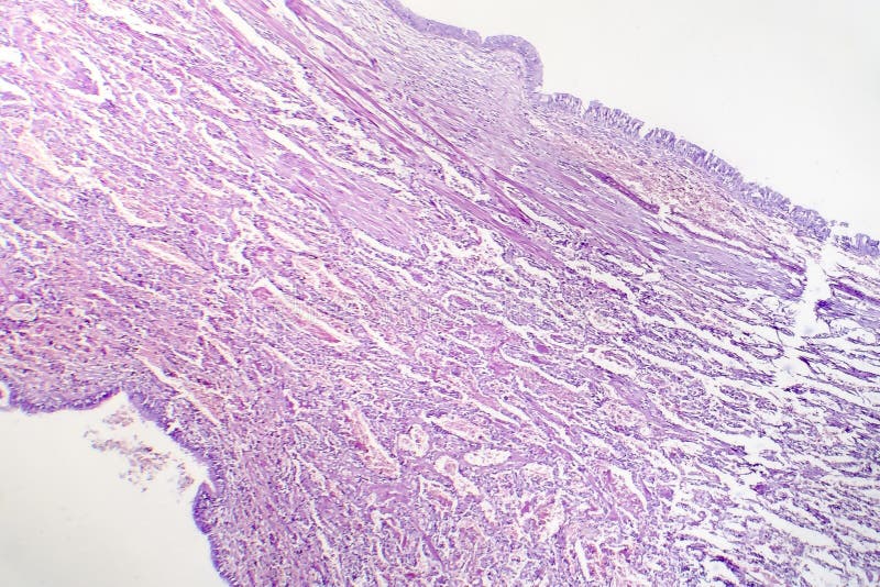 Histopathology of Viral Pneumonia Stock Image - Image of disease ...