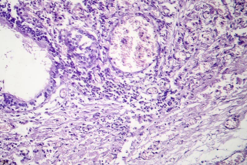 Histopathology of Viral Pneumonia Stock Image - Image of alveoli ...