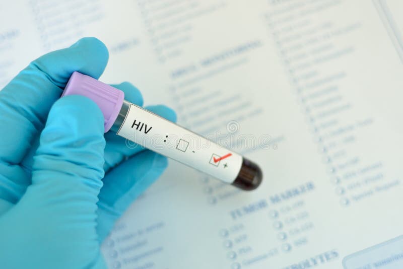 HIV positive stock image. Image of disease, experiment - 55278023
