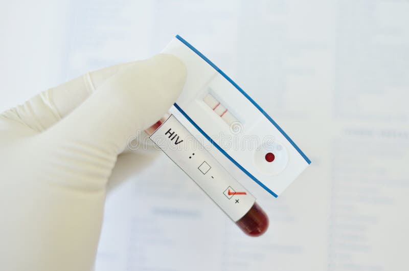 HIV positive stock image. Image of aids, hematology, tube - 54555129