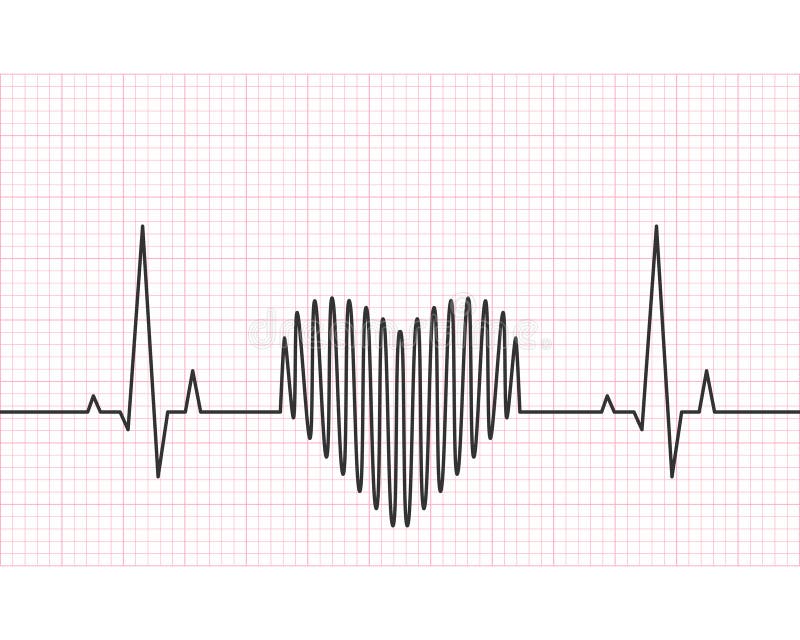 ECG-elektrokardiogram, vektor illustrationer. Illustration av - 30472023
