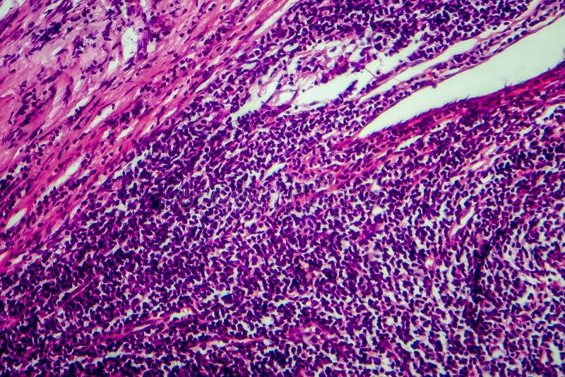 Non-Hodgkin`s Lymphoma, Light Micrograph Stock Photo - Image of micro ...