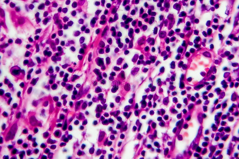 Hodgkin`s Lymphoma, Light Micrograph Stock Photo - Image of microscope ...