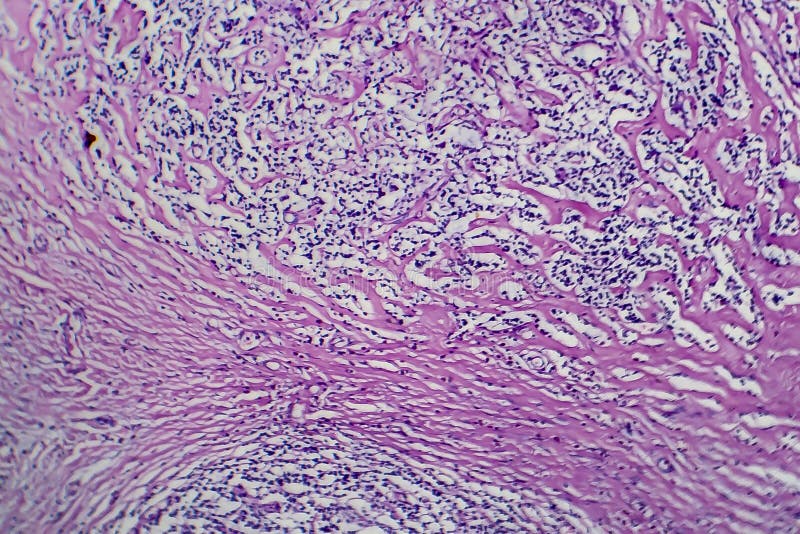 Hodgkin`s Lymphoma, Light Micrograph Stock Image - Image of histology ...