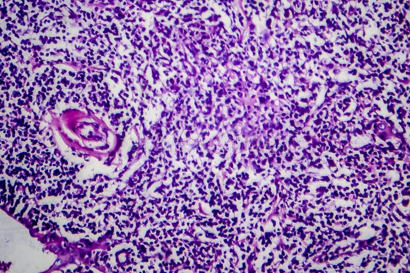 Hodgkin`s Lymphoma, Light Micrograph Stock Photo - Image of tumor ...