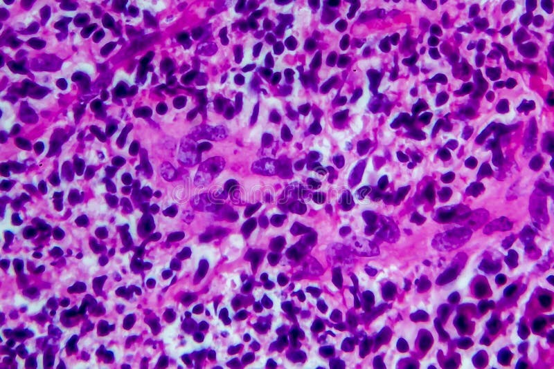 Hodgkin`s Lymphoma, Light Micrograph Stock Photo - Image of cell ...