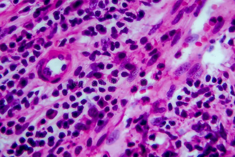 Non-Hodgkin`s Lymphoma, Light Micrograph Stock Photo - Image of micro ...