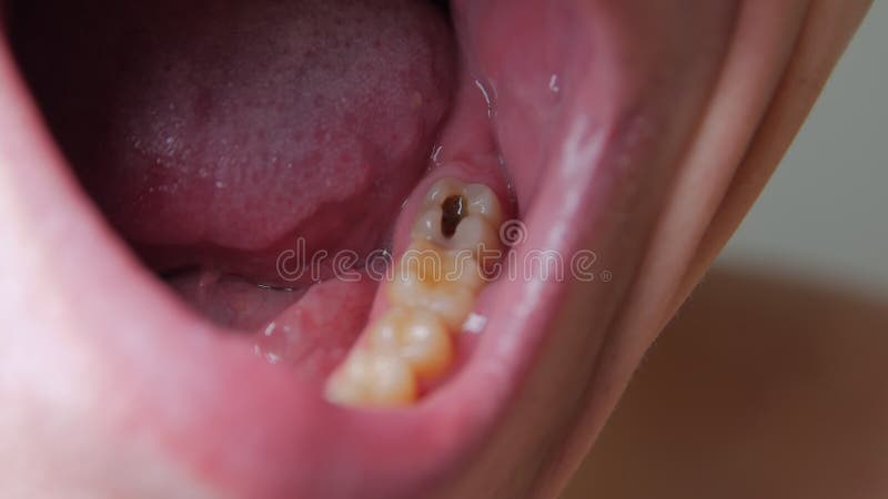 Hole in the Tooth stock video. Video of enamel, yellow - 235989519