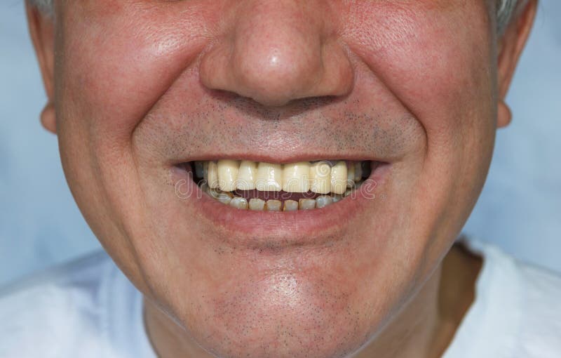 Homem Sem E Dentes Descascados Foto de Stock - Imagem de odontologia ...