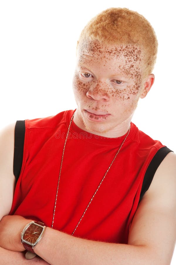 Homme albinos photo stock. Image du différent, humain - 8764130