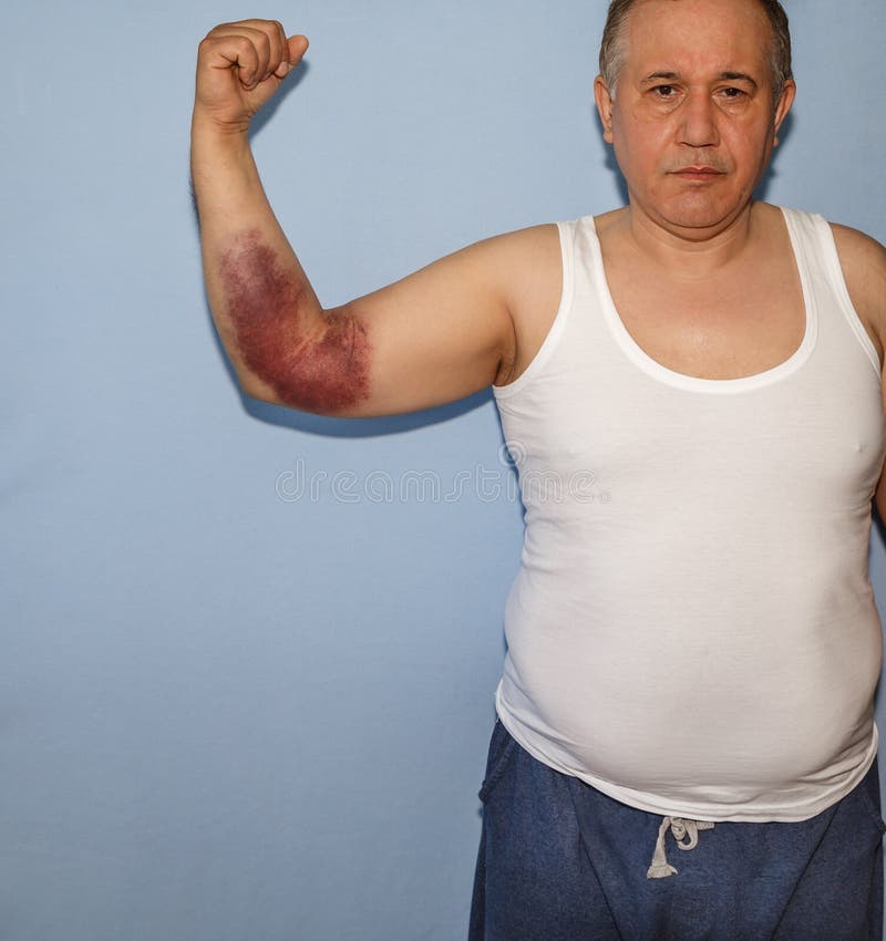 Homme Avec Un Hématome Sur Le Bras Image stock - Image du bleu ...