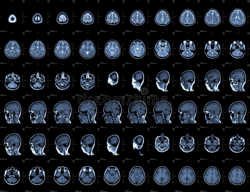 Hoofd MRI stock foto. Image of hoofdpijn, anatomie, aftasten - 4056066