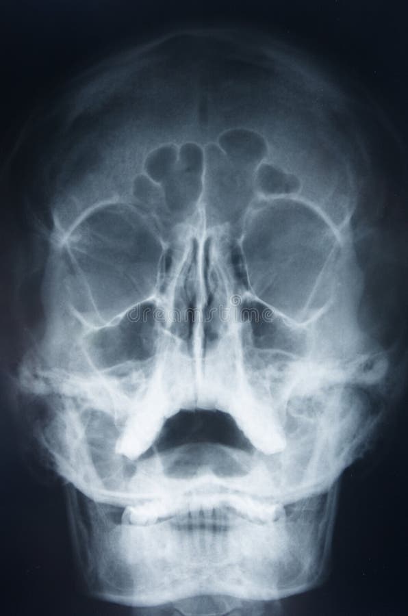 Sinusitis Filmröntgenstraal Van Menselijke Schedel Met Ontstoken Bij ...