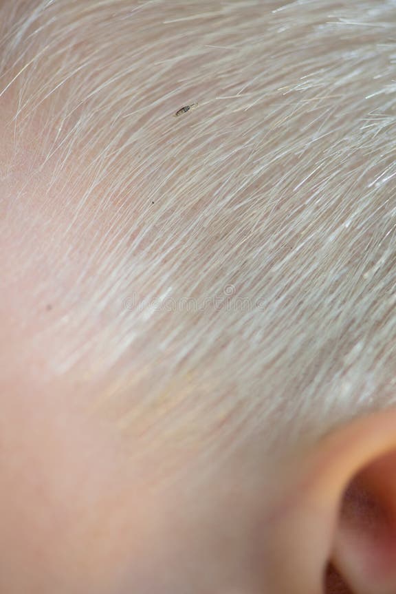 Hoofdluis op hoofd stock foto. Image of behandeling, onderzoek - 56209842