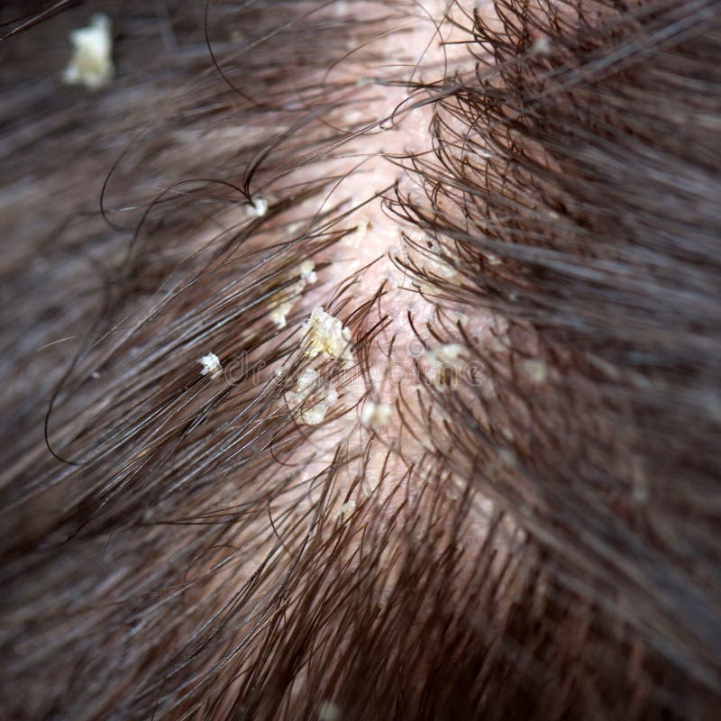 Hoofdroos in Het Haar Vlokkige Scalp Stock Foto - Image of psoriasis ...