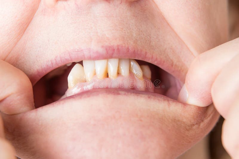 Lower Bottom Back Teeth Missing with Front Exposed. Stock Photo - Image ...