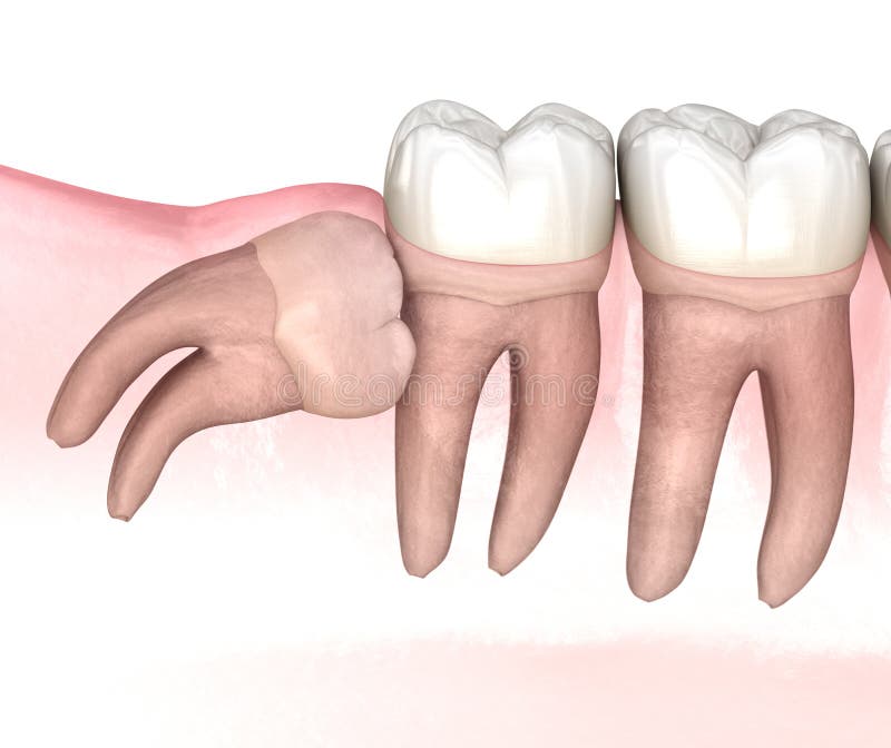 Horizontal Impaction of Wisdom Tooth. Medically Accurate Tooth 3D ...