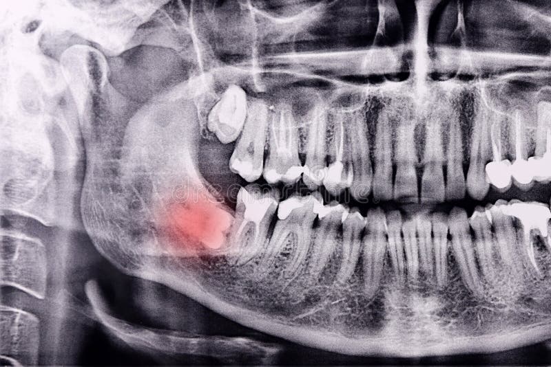 Horizontal Inflamed Wisdom Tooth on Panoramic Dental Tooth X-ray ...