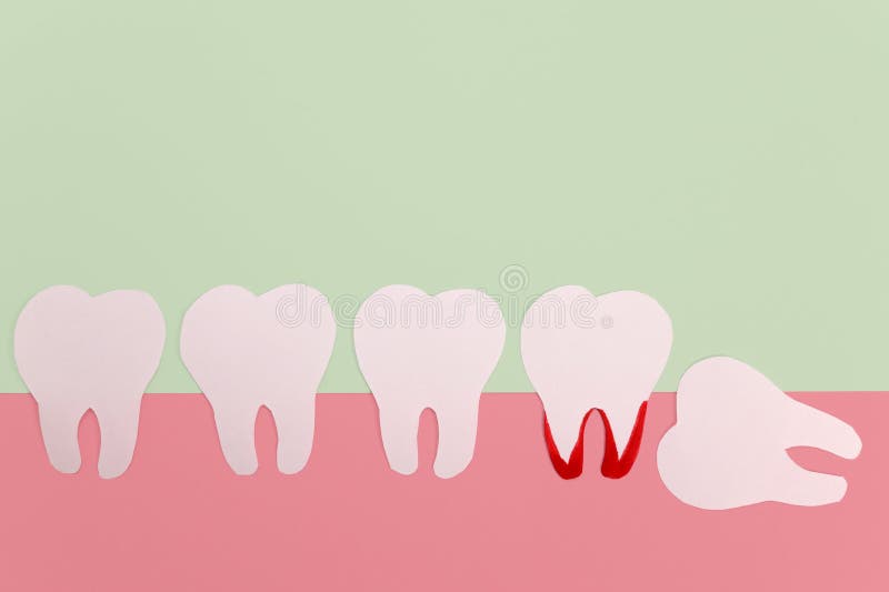 Horizontal, Mesial Wisdom Tooth, Paper Model.the Concept of Services of ...