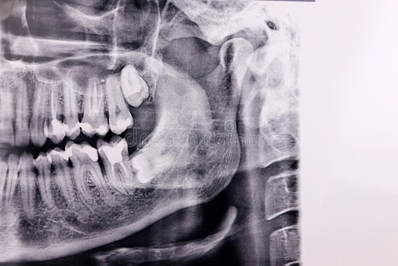 Horizontal Wisdom Tooth on Panoramic Dental Tooth X-ray Examination ...