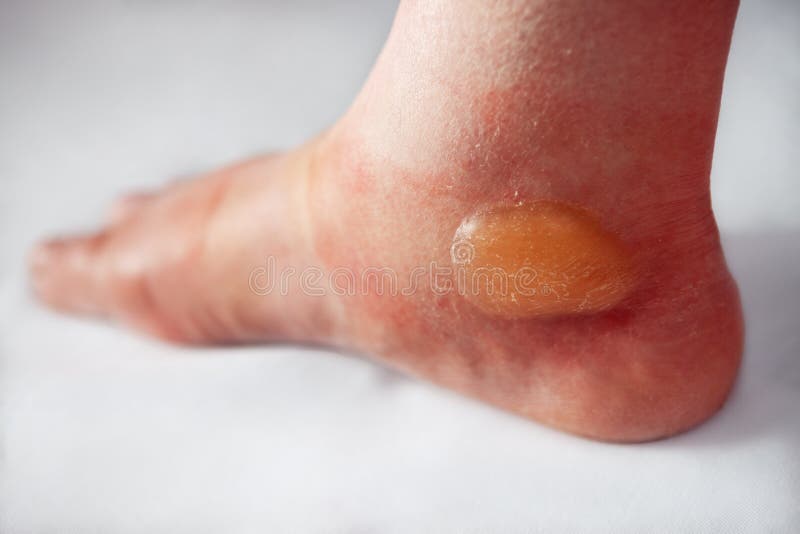Painful Blister on the Burnt Foot Stock Photo - Image of skin, copy ...