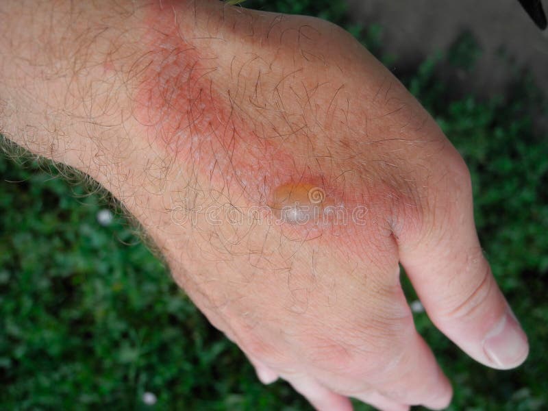 104 Burns Scar Stock Photos - Free & Royalty-Free Stock Photos from ...