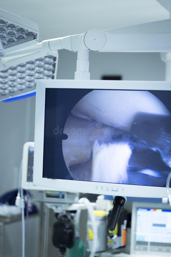 Hospital Surgery Arthroscopy Operation Screen Stock Photo - Image of ...